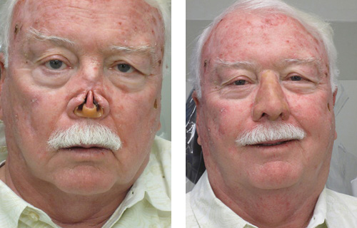 Facial Prosthetics: A Breakthrough - 3D2GO Philippines | 3D Printing ...